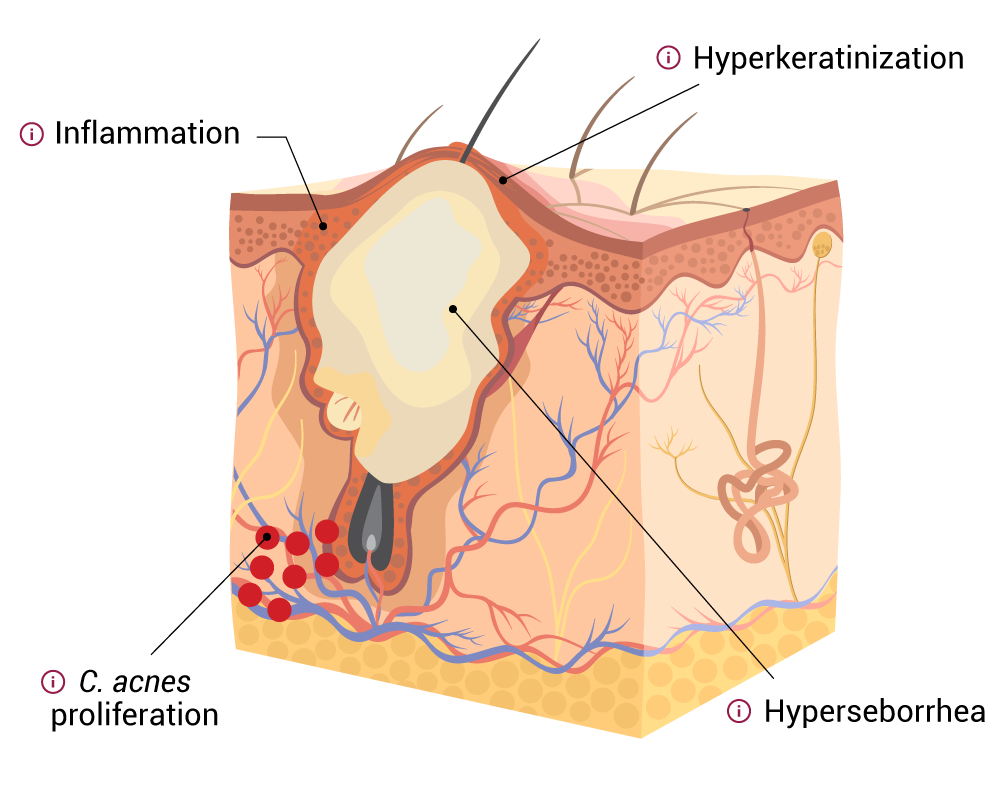 Diagram Of Acne Prone Skin